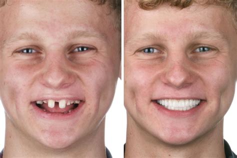 Best Practices For Treating Your Ectodermal Dysplasia Teeth Nfed