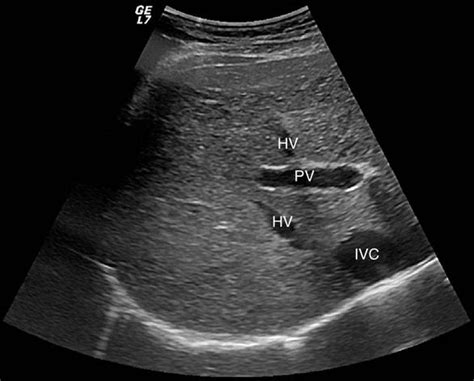 Portal Vein Ultrasound