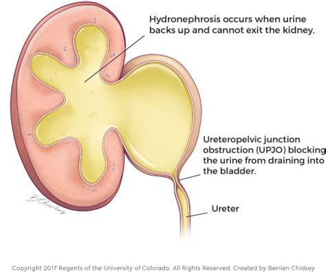 Ureteropelvic Junction Stone Vesicoureteral Reflux Vur Causes