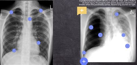 Diagram Of Cxr Case 4 Quizlet