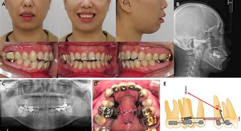 Clinical Application Of A Lingual Retractor With Temporary Anchorage