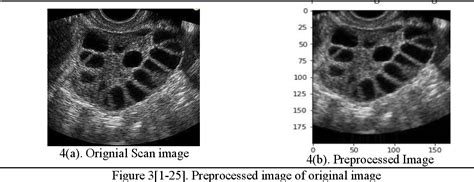Figure 3 1 From Classification Of Pcos Using Machine Learning Algorithms Based On Ultrasound