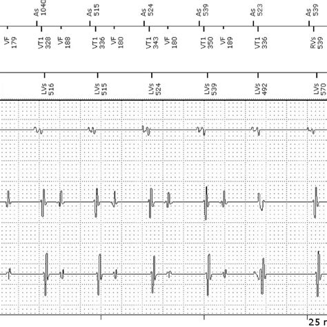 Icd Shock Resulting From Sensing The Near‐field Atrial Electrogram And