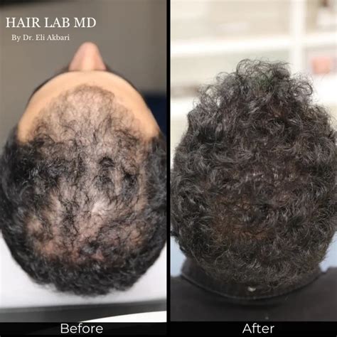 Hair Loss Analysis And Test Monarch Md And Hair Lab Md