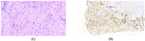 Histopathology Of Case 2 A Low Power Image Showing An Ulcerated Download Scientific Diagram