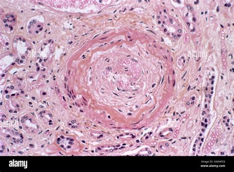 Scleroderma Light Micrograph Of A Vascular Lesion Centre Caused By Scleroderma This Is An