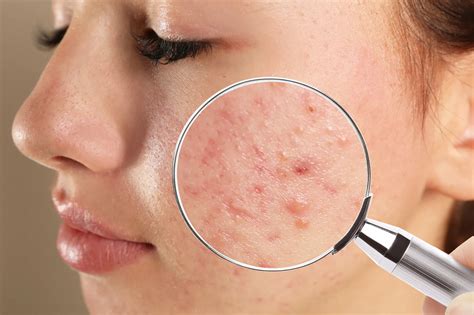 Pcos And Hormonal Acne What Are They Causes Symptoms And Treatments
