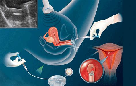 Best Ivf Center In Wakad Best Iui Center In Pune Orion Ivf Center