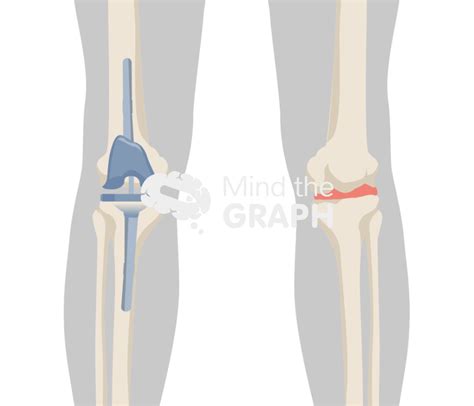 Total Knee Arthroplasty Revision Approach Body
