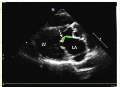 Cardiac Midterm Mitral Valve Stenosis Flashcards Quizlet