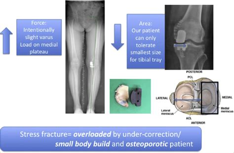 Too Much Varus Increase Loading To Medial Tibial Tray Which May Result Download Scientific