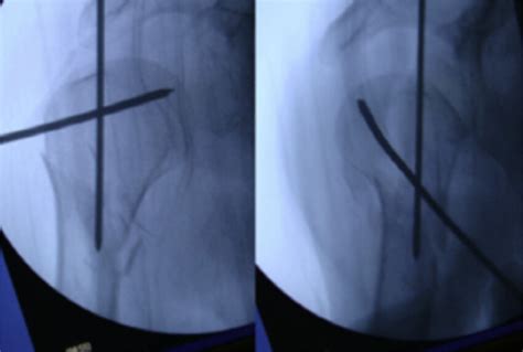 Fluoroscopic Image Demonstrating Kirschner Wire With Reduction Of The