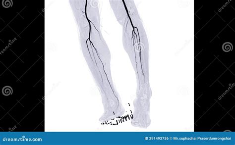 Cta Femoral Artery Run Off Showing Femoral Artery For Diagnostic Acute Or Chronic Peripheral
