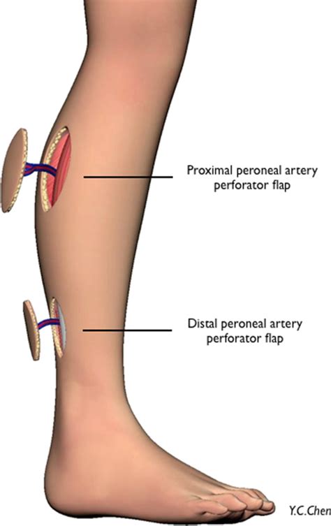 Peroneal Artery