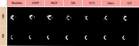 Visualization Comparison Of Pathological Regions Segmentation Effects Download Scientific