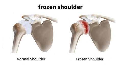 Frozen Shoulder Treatment Melbourne Flynn Chiro Clinic