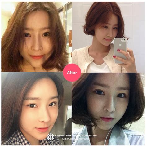 Cinderella Plastic Surgery Cinderella Plastic Surgery Before And After
