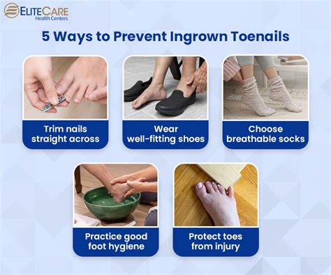 How To Cut Toenail To Prevent Ingrown Detroit Chinatown