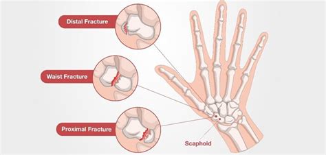 Scaphoid Fracture Of The Wrist Symptoms Causes And Treatment