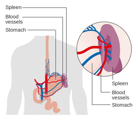 Laparoscopic Splenectomy Complications Recovery And Surgery Texas