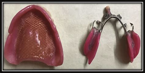 Complete Maxillary Denture Download Scientific Diagram