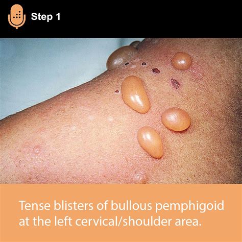 Bullous Pemphigoid