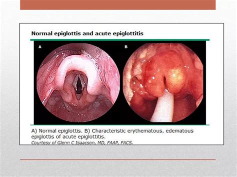 Upper Airway Obstruction Pptx