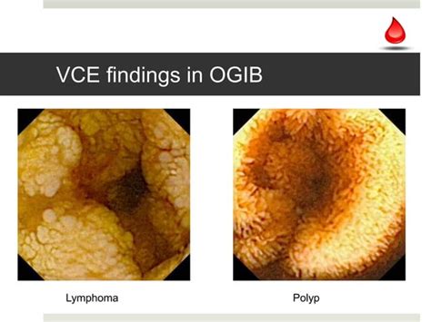 Obscure Gi Bleeding Pptx