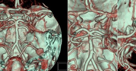 Radiology Mri Persistent Trigeminal Artery