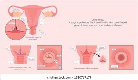 Removal Of Sexual Warts Images Stock Photos Vectors Shutterstock