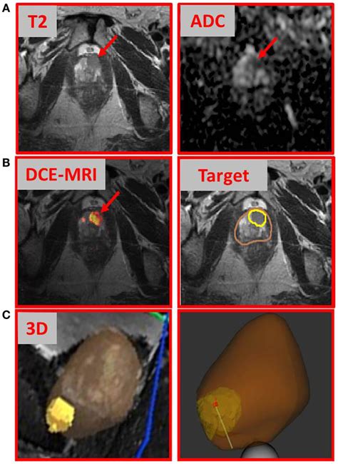 What Is A Multiparametric Mri Prostate At Timothy Gordon Blog