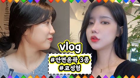 뿌매바버 Vlog Hoxy브이라인에 베여봤어매부리코→완벽 코라인🎉쿠키영상 안보면 후회해~ 윤곽수술 3종광대사각턱