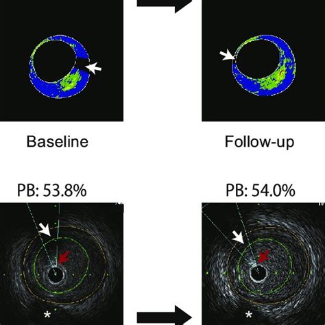 Representative Conventional IVUS And IB IVUS Images Of The Cross Download Scientific Diagram