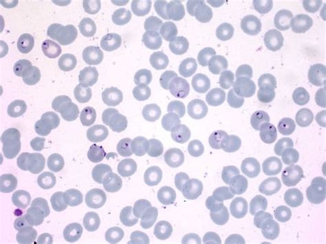 Plasmodium Falciparum Parasite Diagnosis