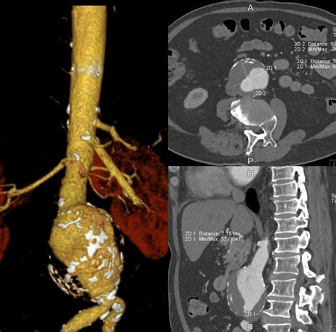 Computed Tomography Abdominal Aortogram Measured A 715 Cm × 567 Cm × Download Scientific