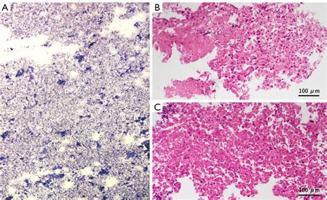 Needle Tract Seeding After Endobronchial Ultrasound Guided Intranodal
