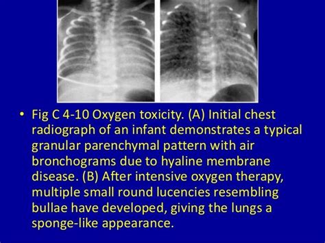4 Diffuse Reticular Or Reticulonodular Pattern