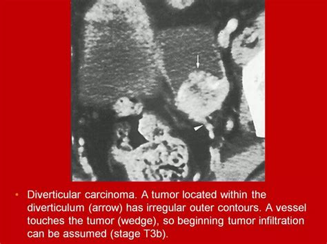 Whole Body Computed Tomography Urinary Bladder Ppt