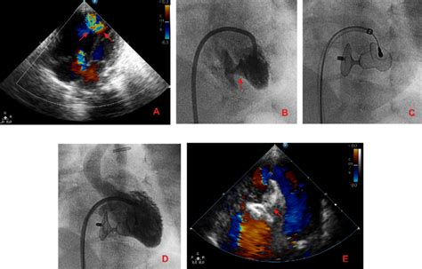 Mid Muscular VSD Panel A TEE Chambers View Shows The Download Scientific Diagram