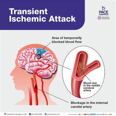 Brain Stroke Types Causes Symptoms Prevention And Treatment