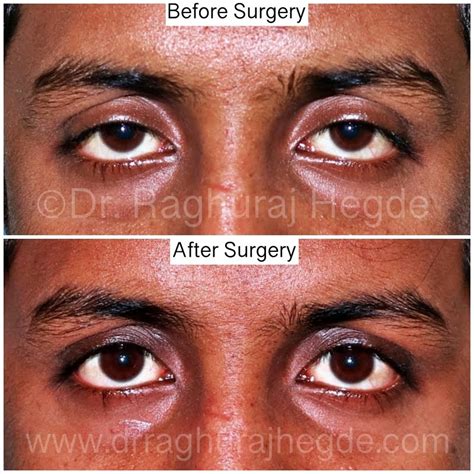 Droopy Eyelids Dr Raghuraj Hegde
