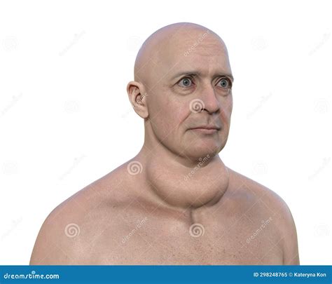 A Man With Enlarged Thyroid Gland 3d Illustration Stock Illustration Illustration Of Colloid