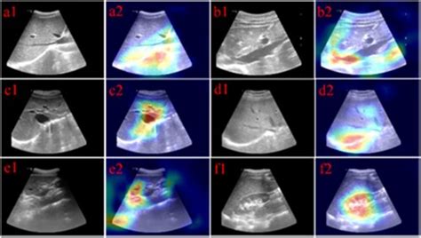 Full Article Automatic Classification Method Of Liver Ultrasound Standard Plane Images Using