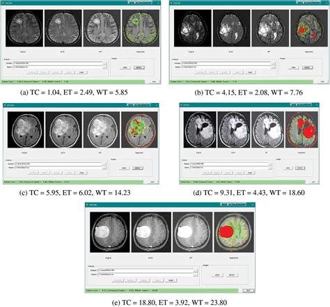 Csse Free Full Text Brain Tumor Hybrid Feature Extraction Based On Unet And 3dcnn