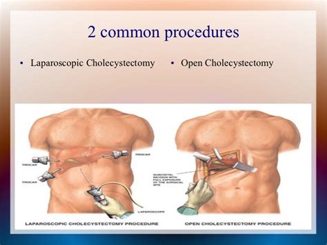 Cpt Code Open Cholecystectomy At Aurora Mcdonald Blog
