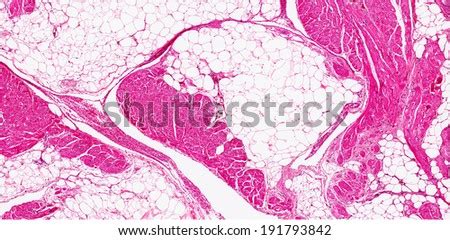 Fat Infiltration Of The Heart Fatty Infiltration Of The Myocardium Fat Cells Infiltrating The
