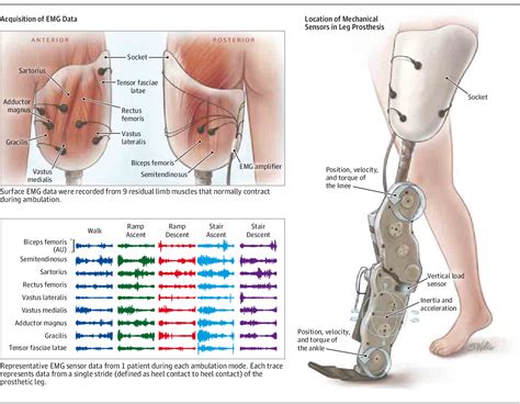 Figure 1 From Intuitive Control Of A Powered Prosthetic Leg During Ambulation A Randomized
