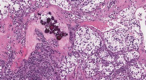 Tfe3 Rearranged Renal Cell Carcinoma