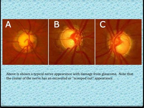 Congenital Glaucoma Part 1 Pptx