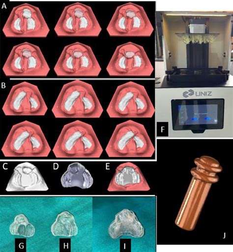 A Dual Layered 3d Printed Appliance For Pre Surgical Orthopedics In